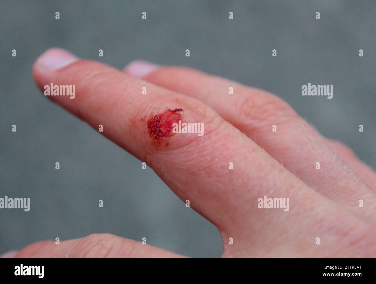 Finger infection hi-res stock photography and images - Alamy