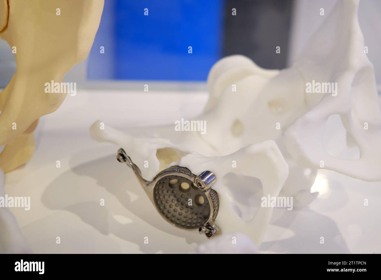 The artificial hip for the hip joint enables adults with hip ...