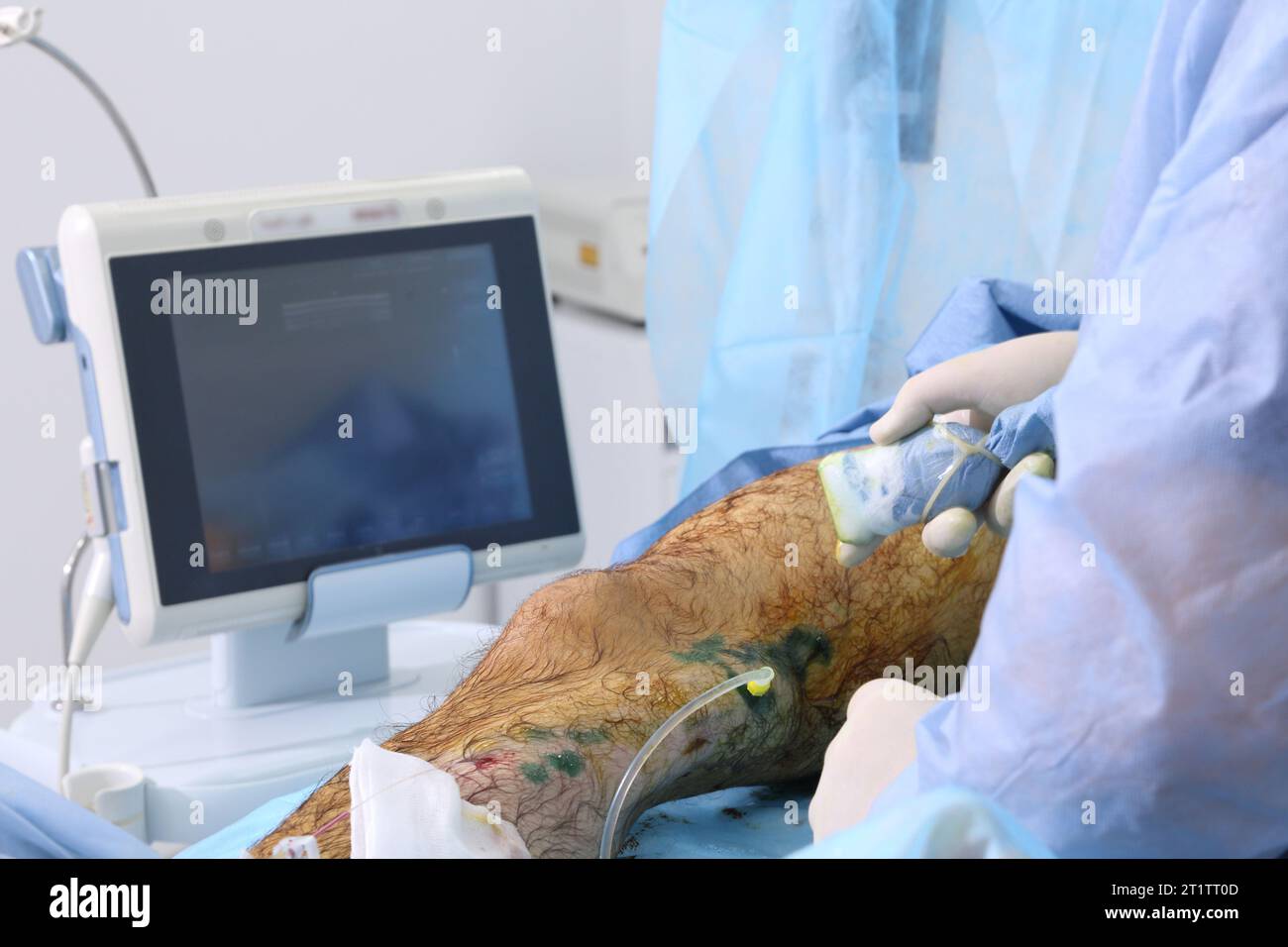 Medical surgery for endovenous laser photocoagulation of the great ...