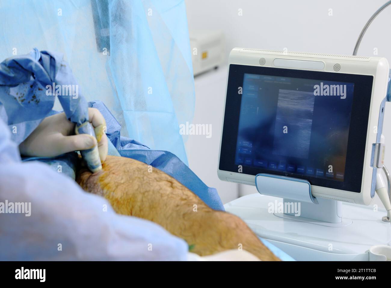 Medical surgery for endovenous laser photocoagulation of the great ...