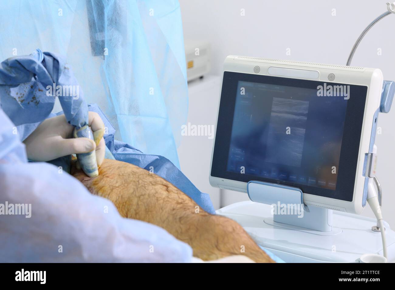 Endoscopic Laser Coagulation Therapy at Kimberly Hawthorne blog