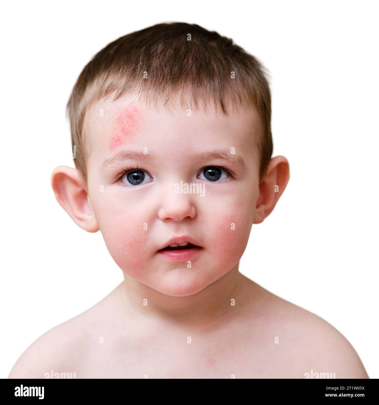 Toddler baby face with scratch on forehead, isolated on white ...