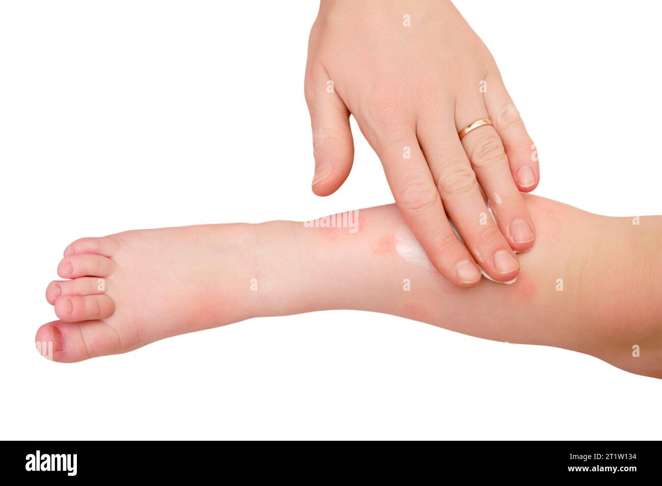 Toddler baby skin care, allergies and dermatitis, isolated on white ...