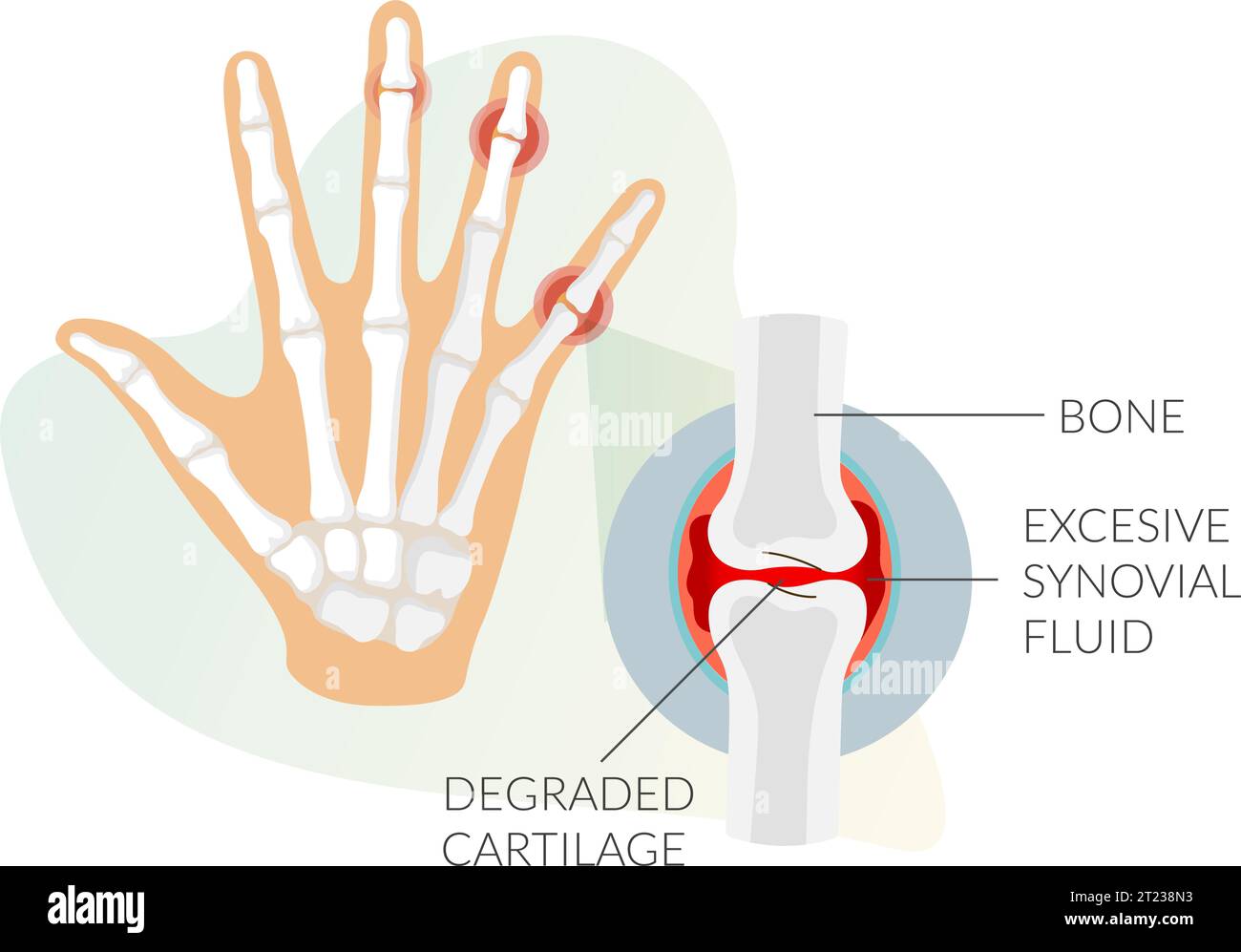 Gout of the finger joint Stock Vector Images - Alamy