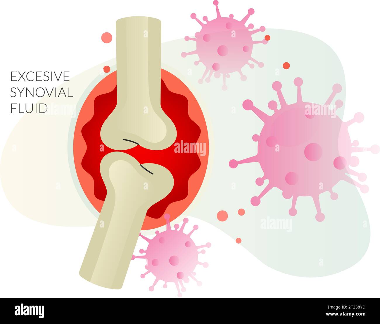 Inflammation - Joint Pain - Rheumatoid arthritis as Stock Illustration ...