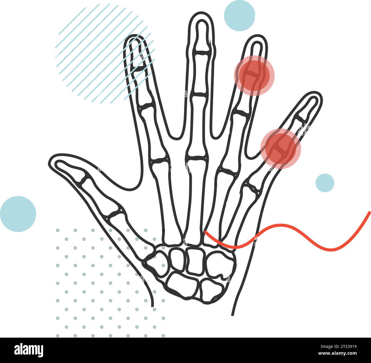 Inflamation - Finger Joint Pain as Stock Illustration as EPS 10 File ...
