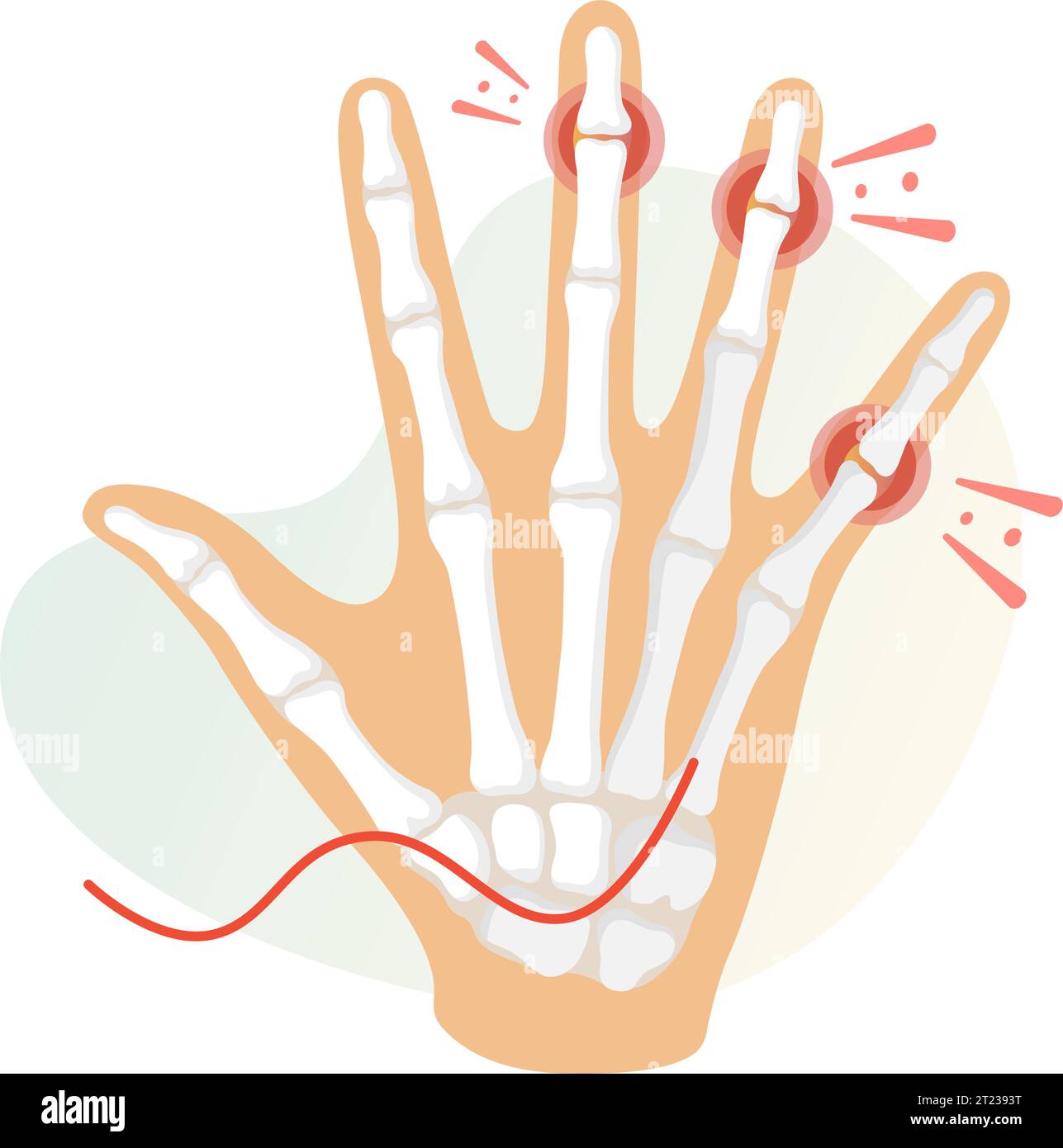 Inflamation - Finger Joint Pain as Stock Illustration as EPS 10 File ...