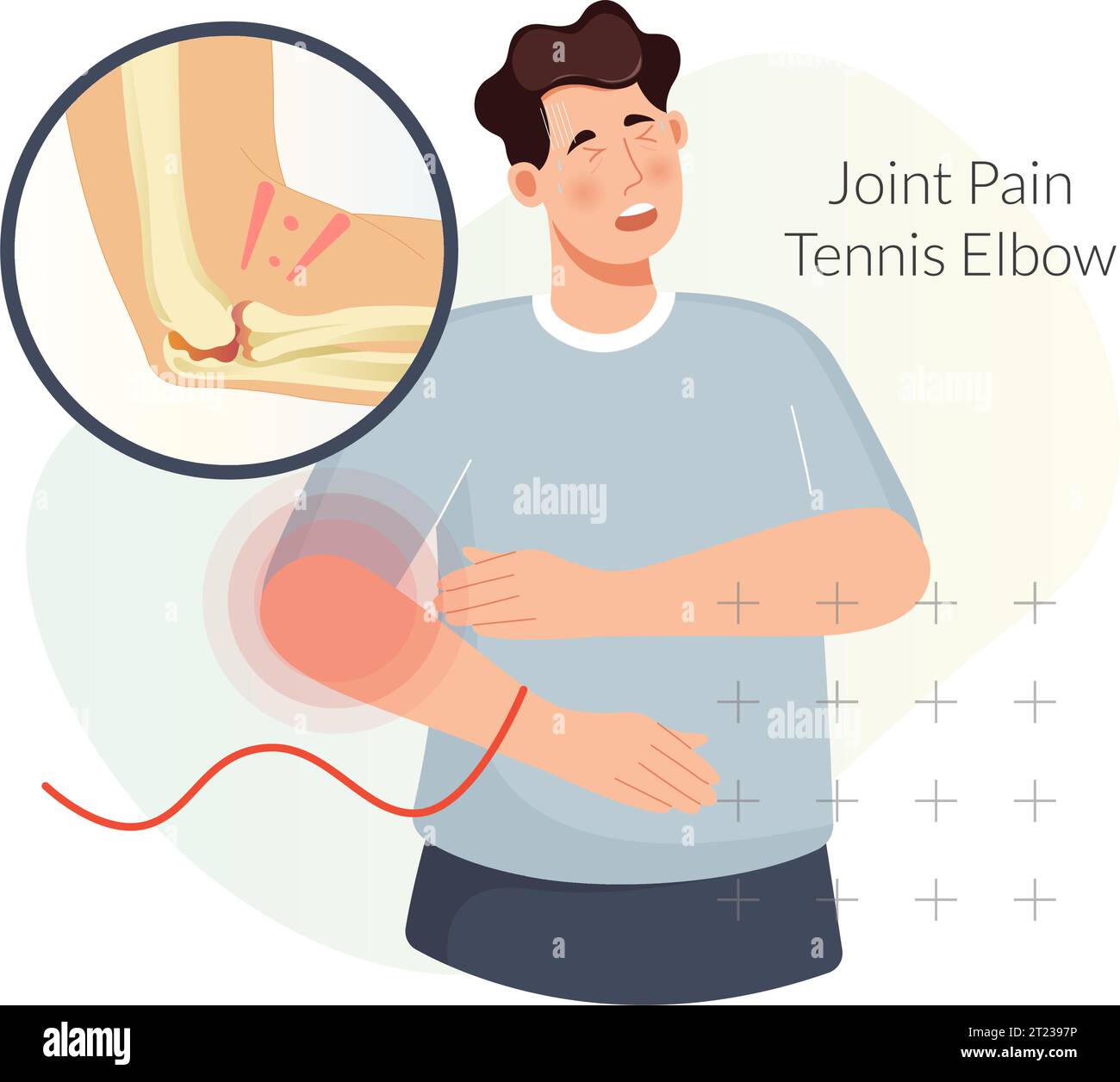 Lateral Epicondylitis known as Tennis Elbow - Stock Illustration as EPS ...
