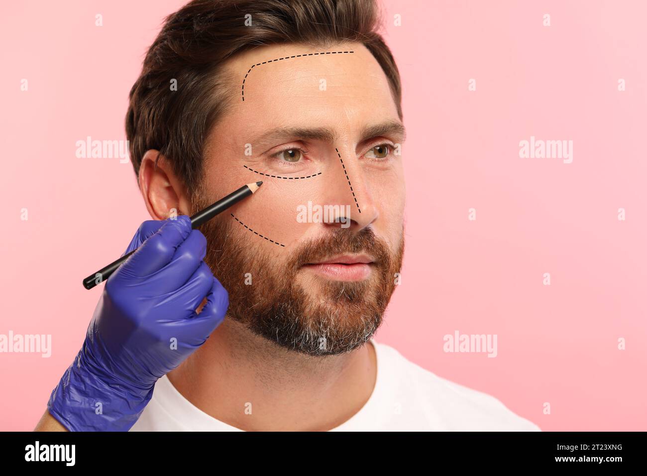 Man preparing for cosmetic surgery, pink background. Doctor drawing ...