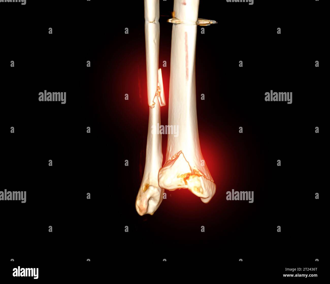 CT Scan ankle joint 3D Rendering image showing fracture tibia and ...