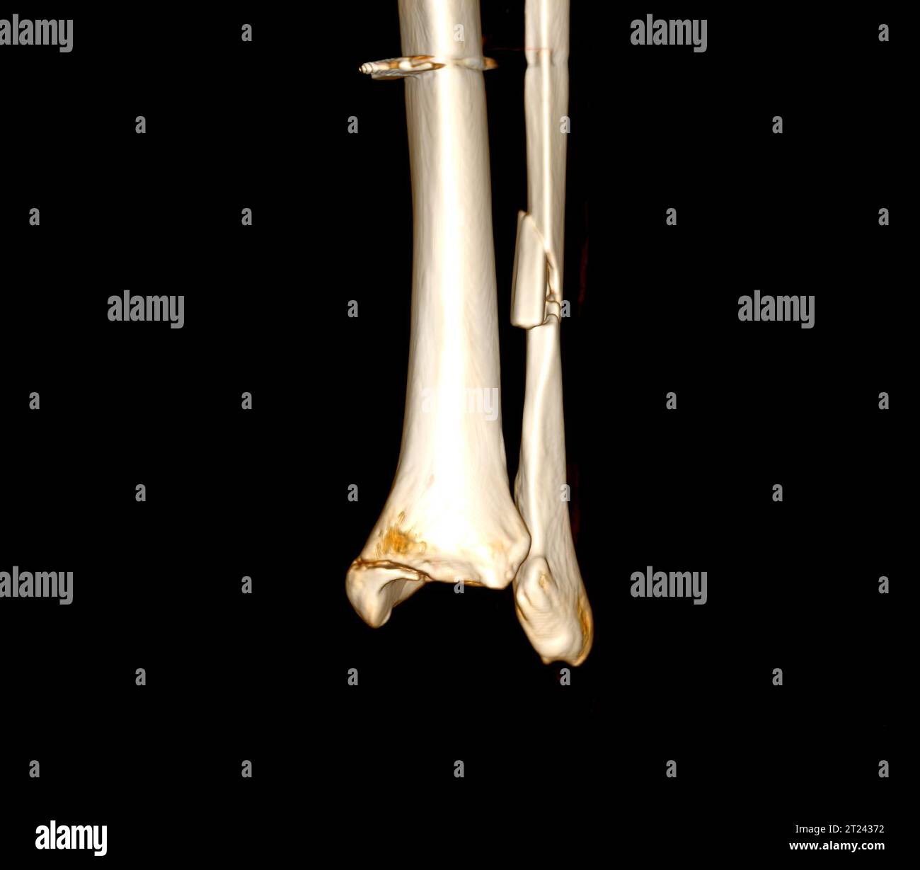 CT Scan ankle joint 3D Rendering image showing fracture tibia and ...