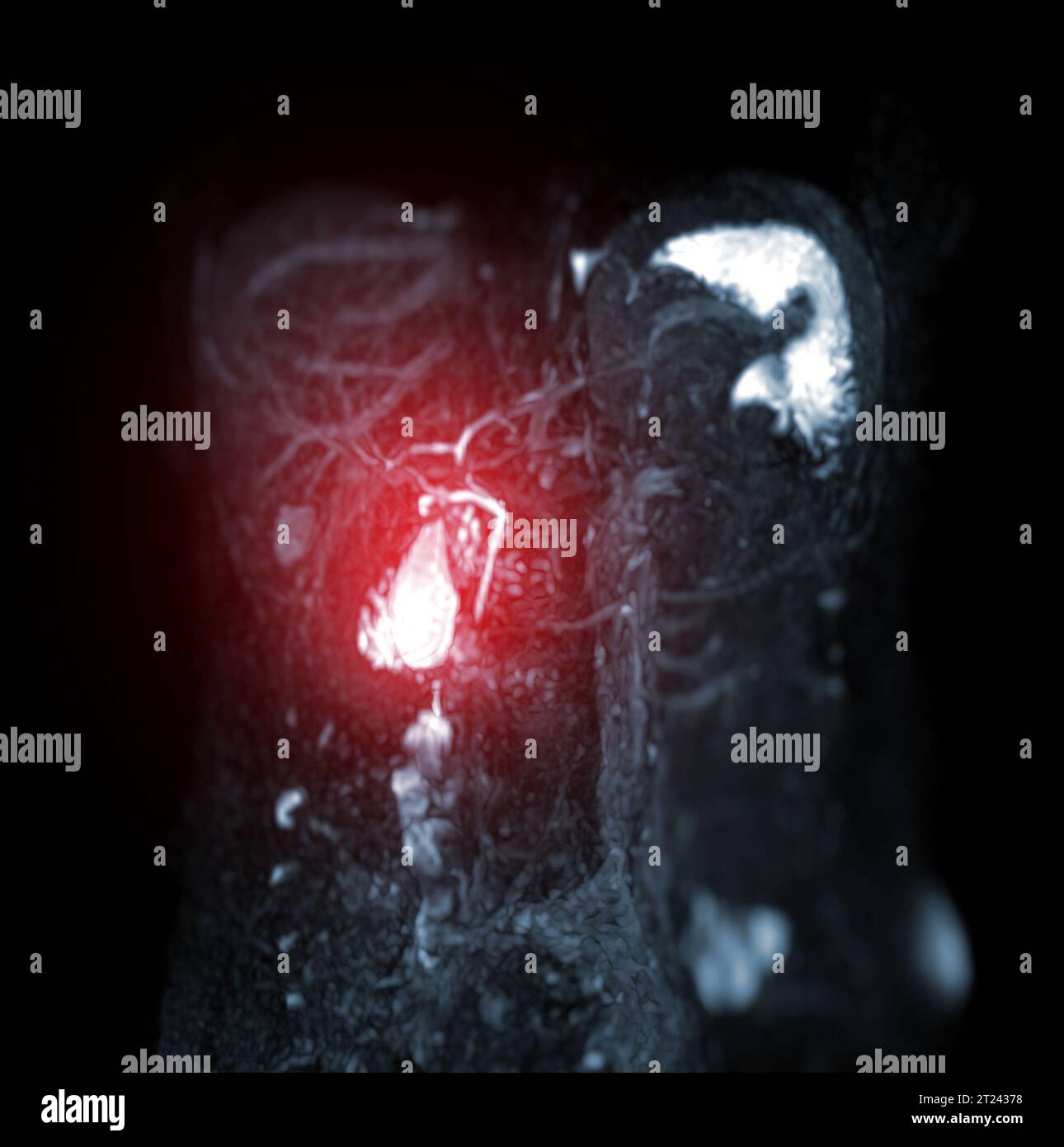 Magnetic Resonance Cholangiopancreatography Or Mrcp Showing Gallbladder Biliary And Pancreatic