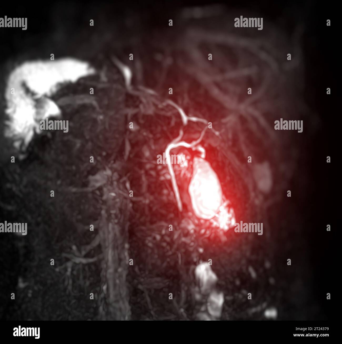 Magnetic Resonance Cholangiopancreatography Or Mrcp Showing Gallbladder Biliary And Pancreatic