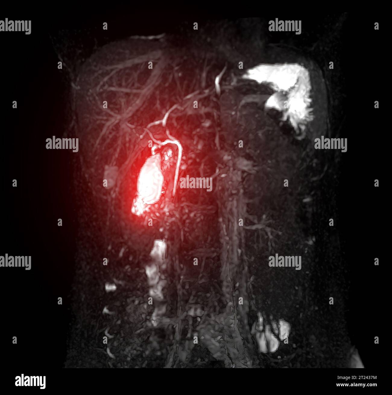 Magnetic Resonance Cholangiopancreatography Or Mrcp Showing Gallbladder