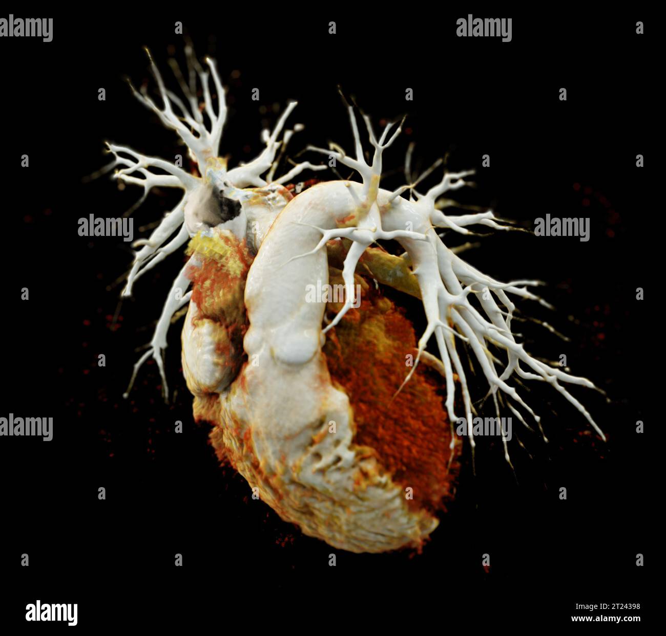 CTA Chest or CTPA with contrast media 3D rendering for diagnostic ...