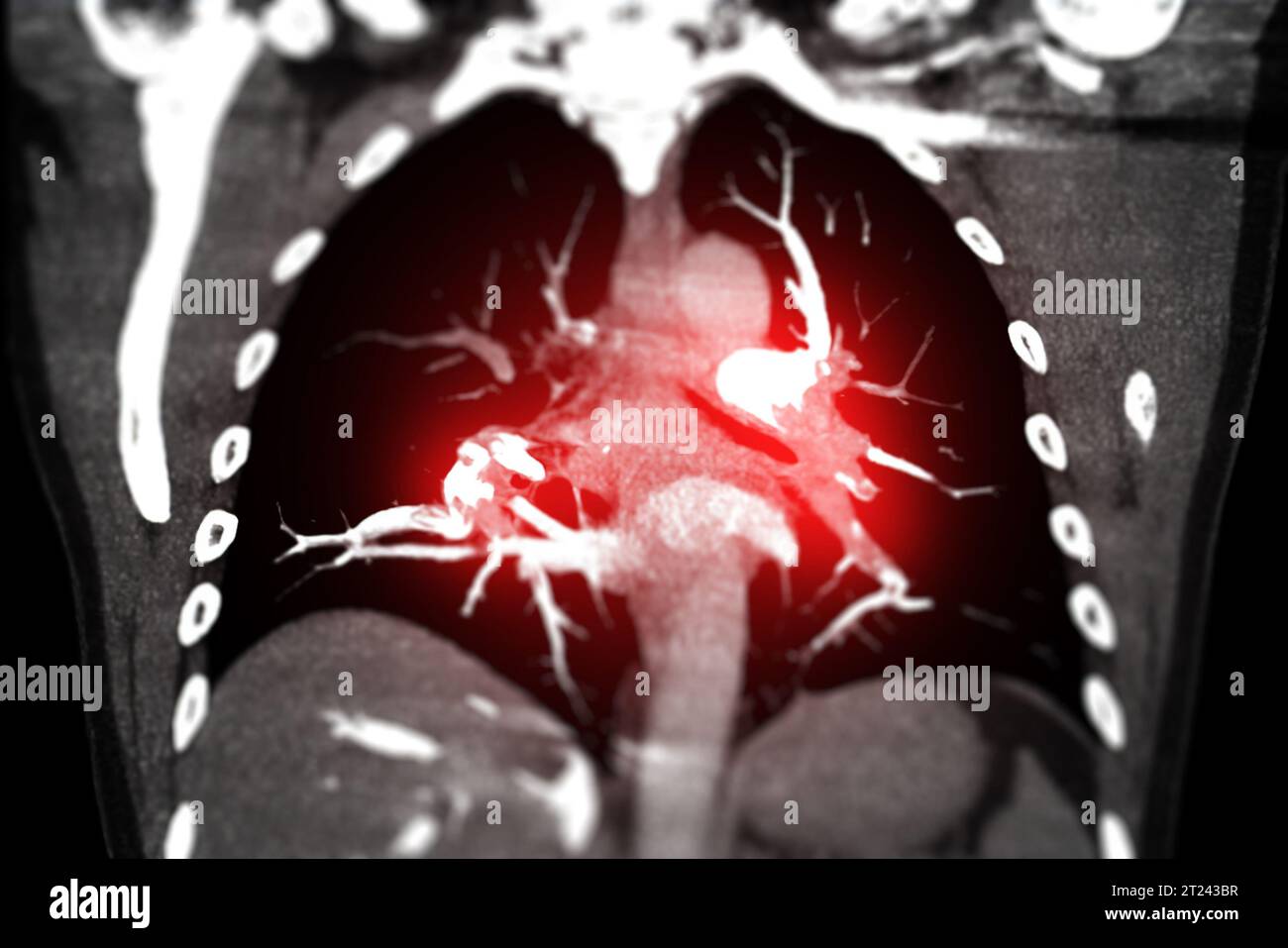 CTA Chest or CTPA with contrast media coronal view showing Pulmonary ...