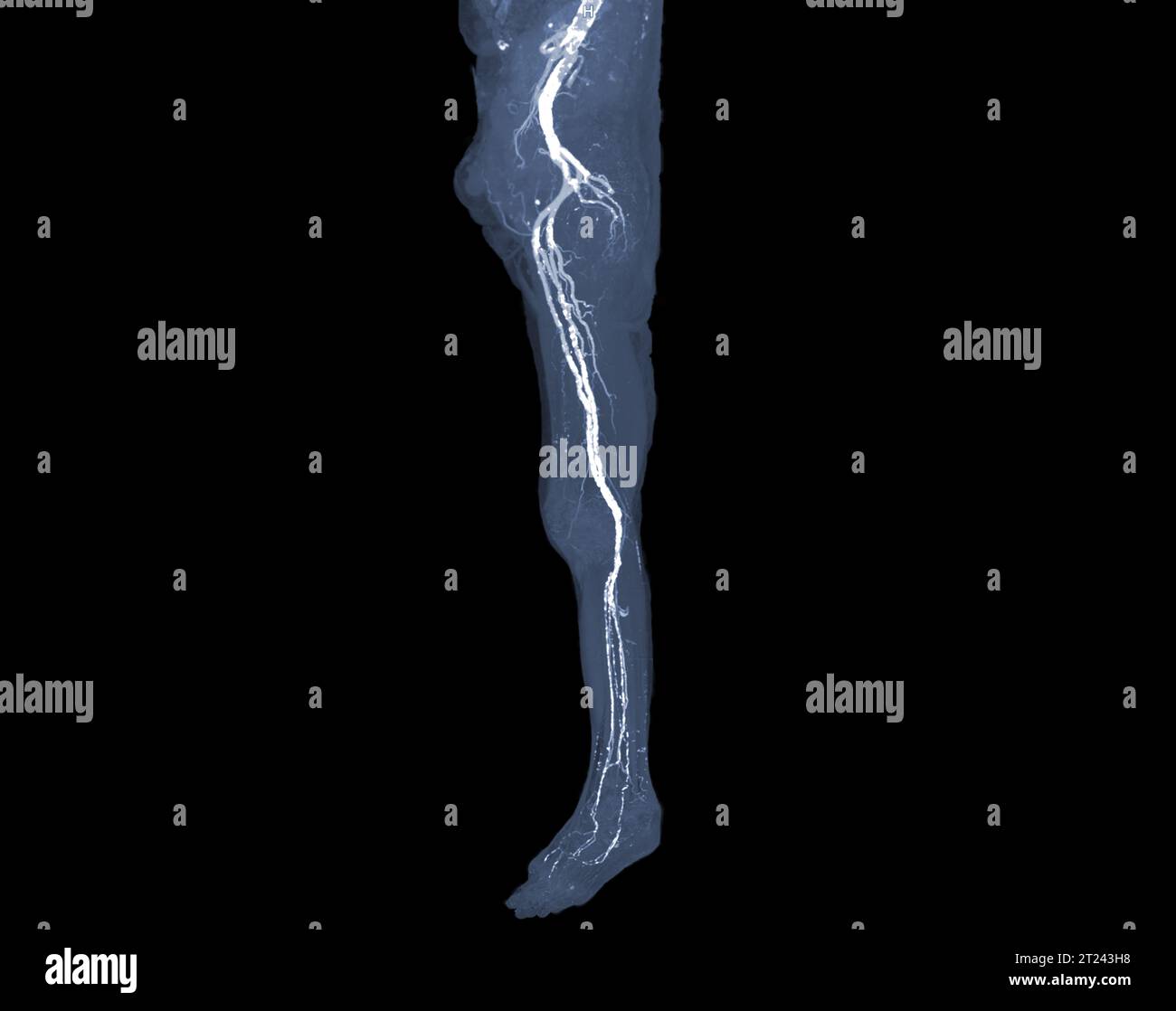 CTA femoral artery run off image of femoral artery for diagnosis Acute ...