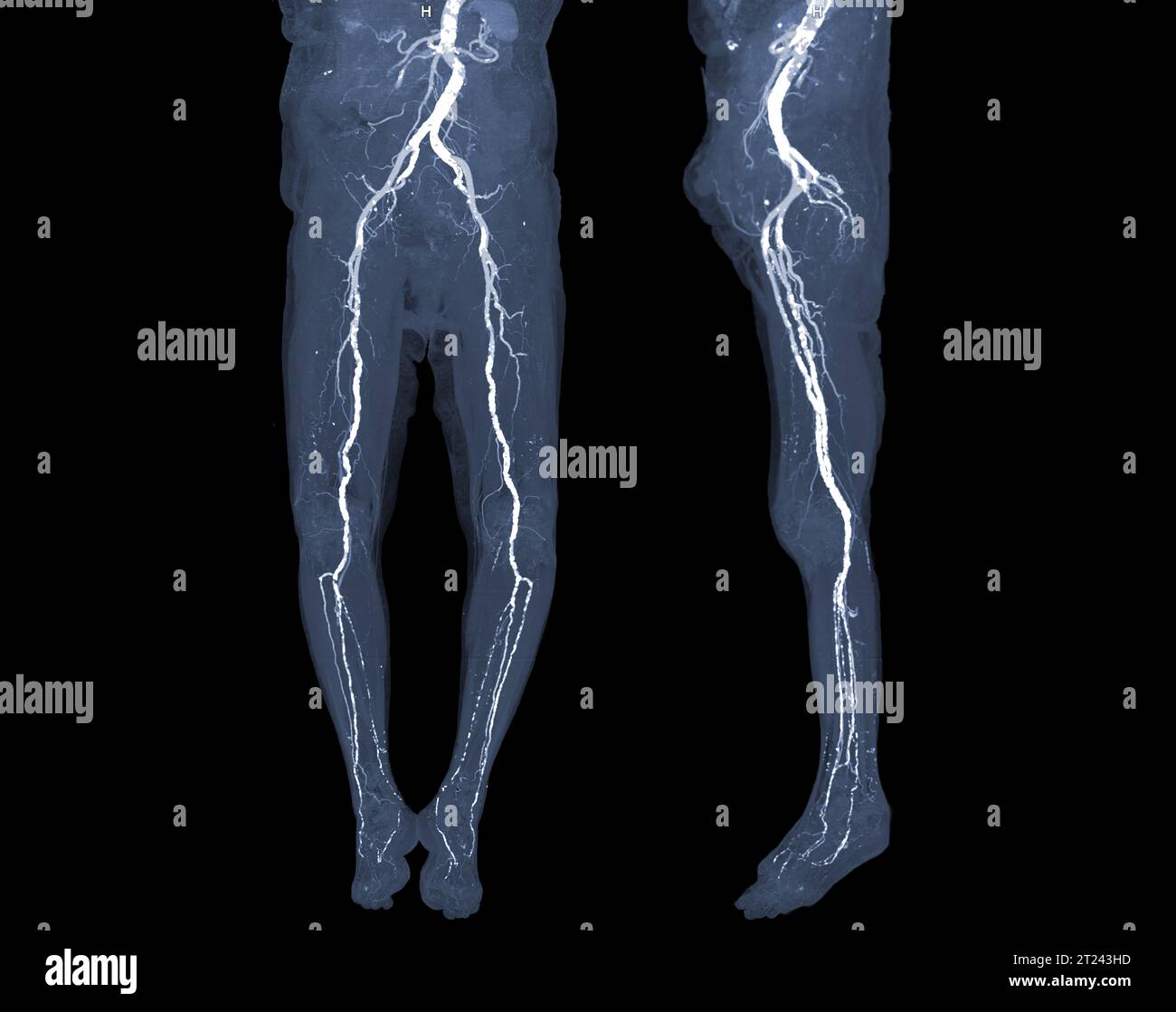 CTA femoral artery run off image of femoral artery for diagnosis Acute ...
