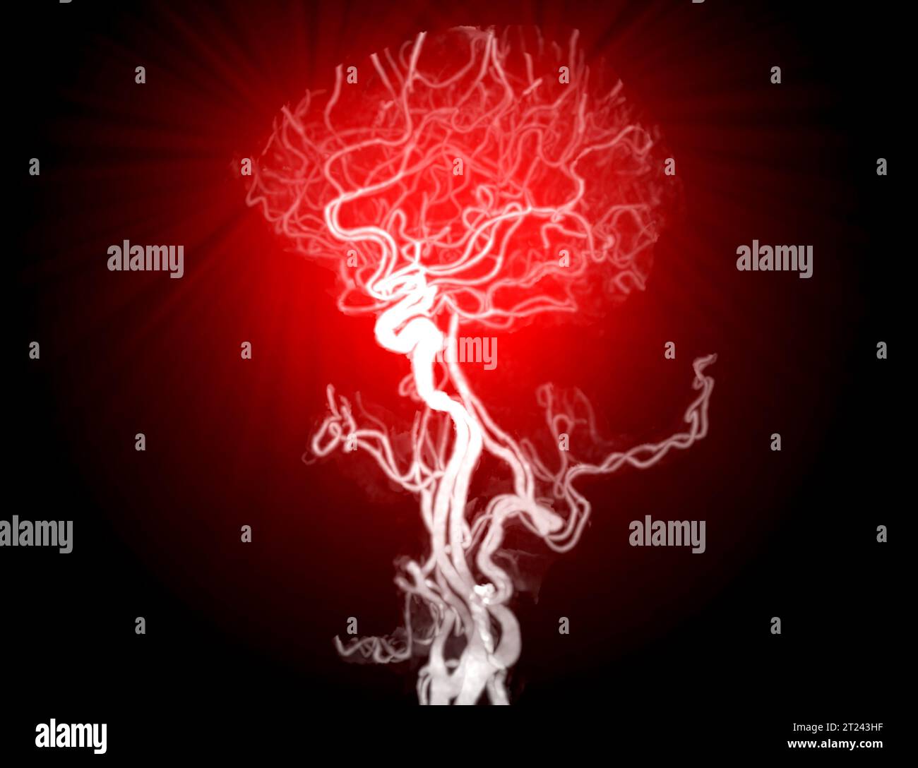 CT angiography of the brain or CTA brain showing noraml cerebral artery ...