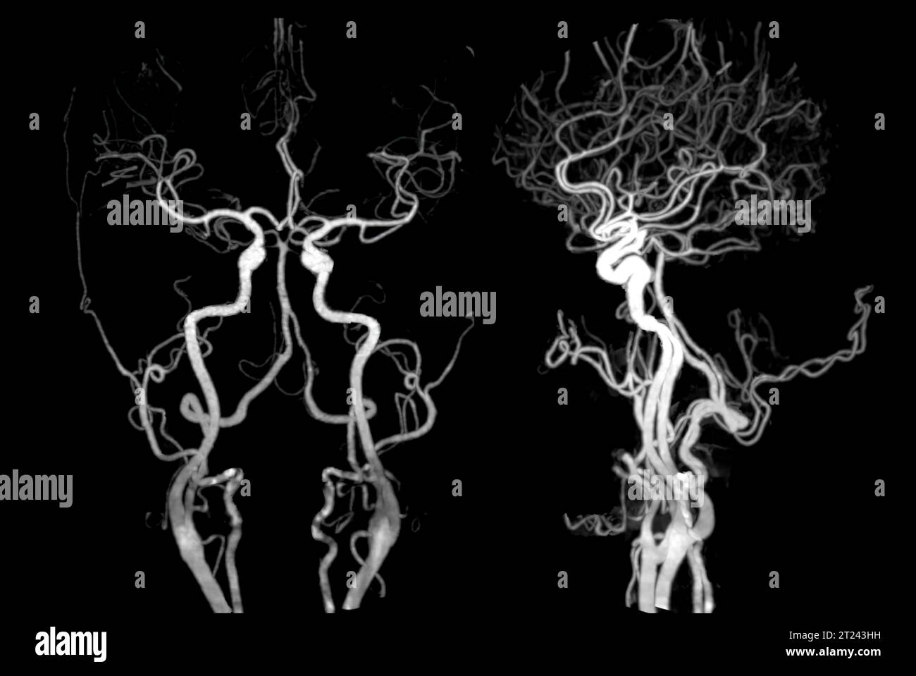 CT angiography of the brain or CTA brain showing noraml cerebral artery ...