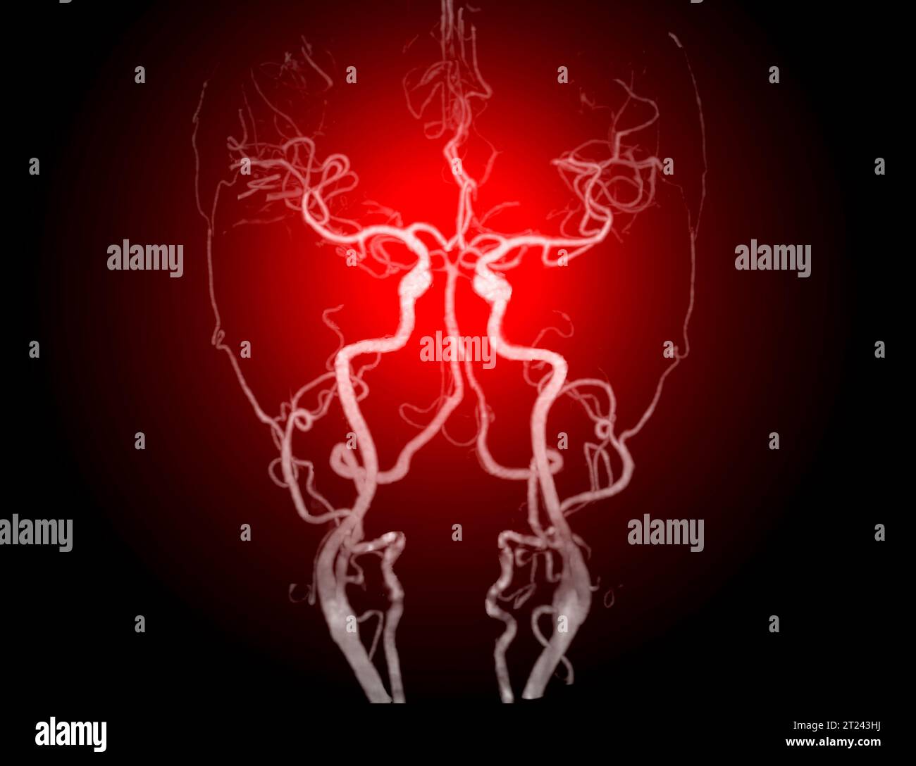 Brain artery angiogram hi-res stock photography and images - Alamy