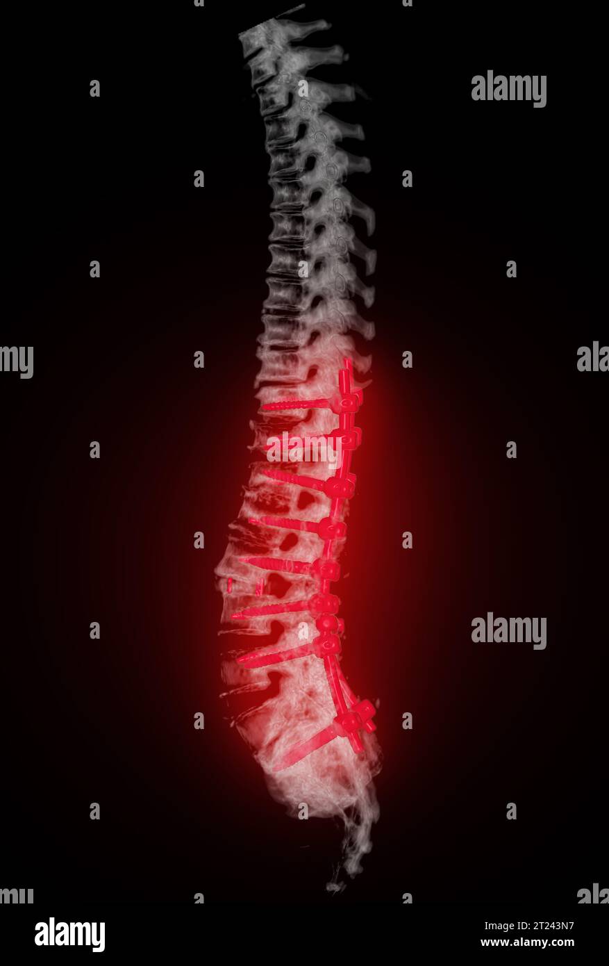 CT scan of thoracic and lumbar spine 3d rendering showing pedicle screw ...