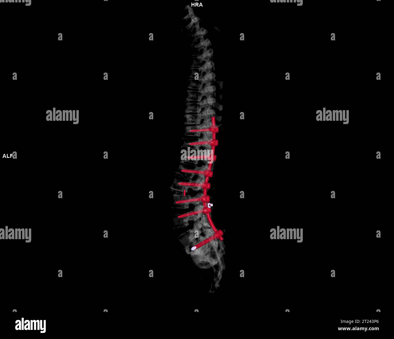 CT scan of thoracic and lumbar spine 3d rendering showing pedicle screw ...