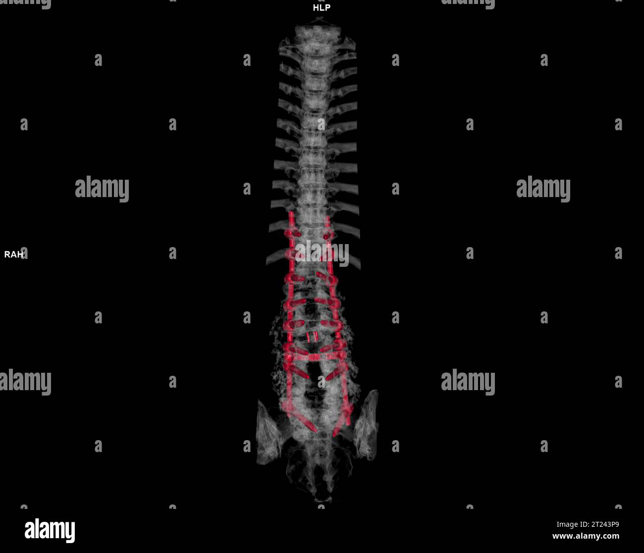CT scan of thoracic and lumbar spine 3d rendering showing pedicle screw ...