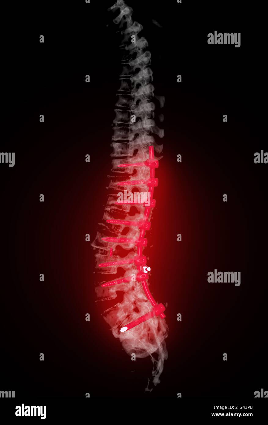 CT scan of thoracic and lumbar spine 3d rendering showing pedicle screw ...