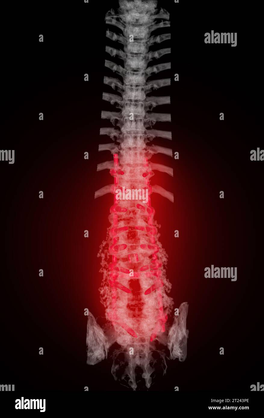 CT scan of thoracic and lumbar spine 3d rendering showing pedicle screw ...
