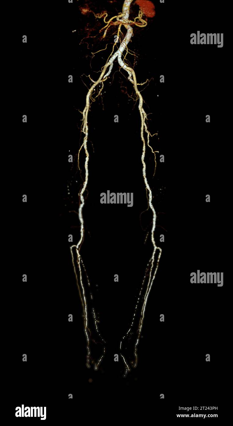 CTA femoral artery run off image of femoral artery for diagnosis Acute ...