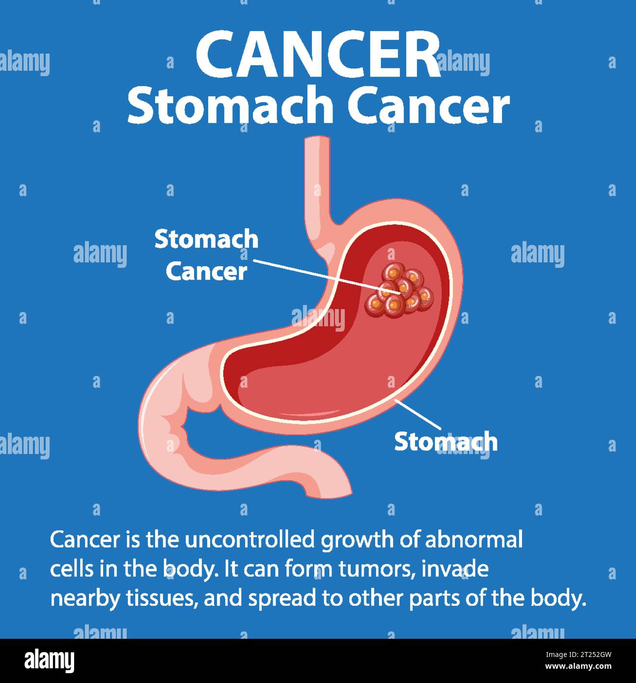 Visual representation of abnormal cell growth in stomach cancer Stock ...