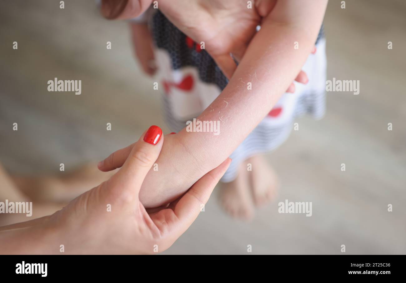 Woman examining red rash on arms of child, irritation on girls body ...