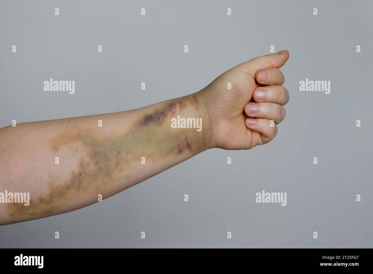 Car accident bruise on the woman's skin Stock Photo - Alamy