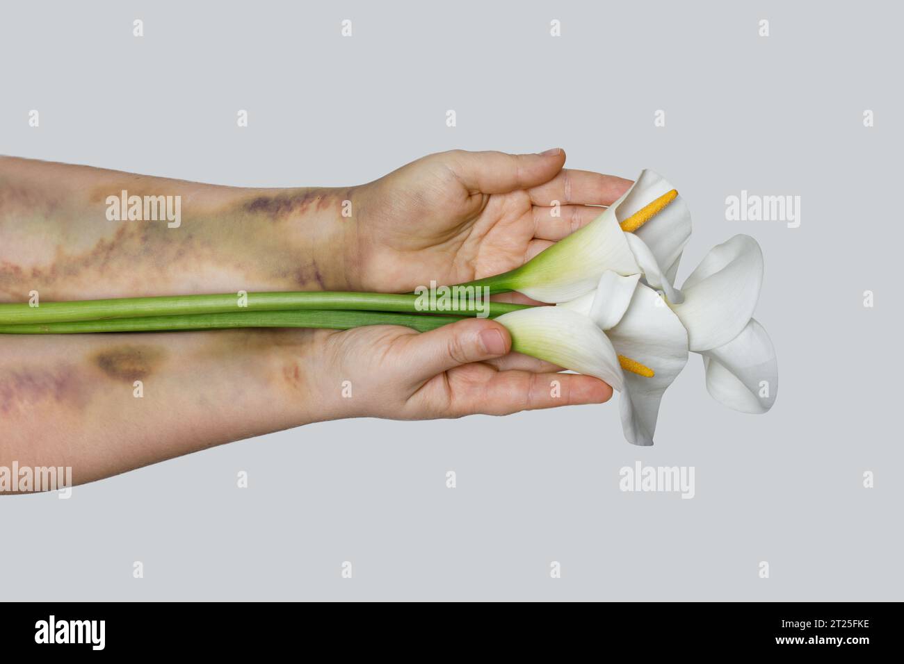 Female hand with issues bruise holding white delicate lily flower ...