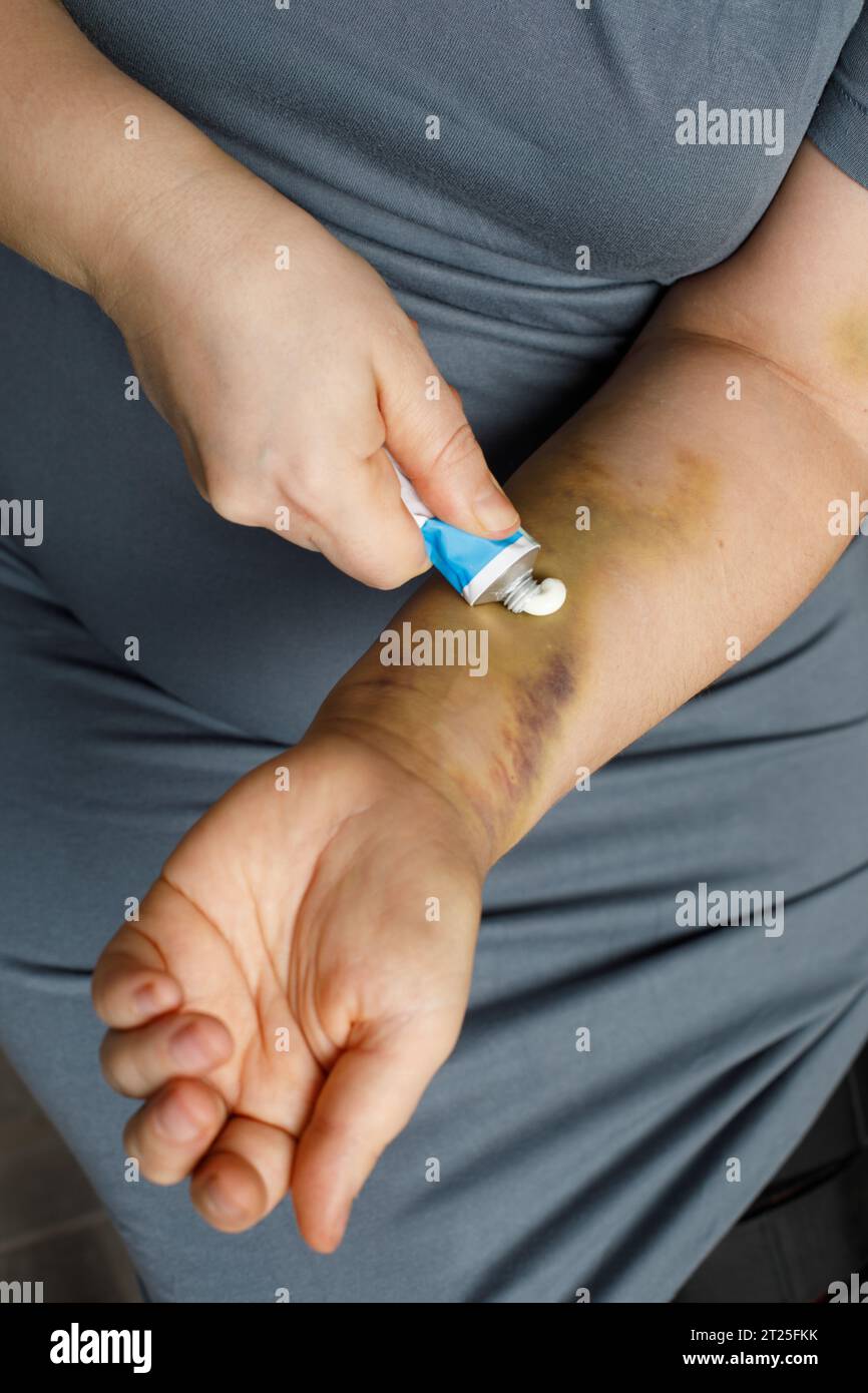 Woman having bruise on her arm from accident and using medicine cream ...