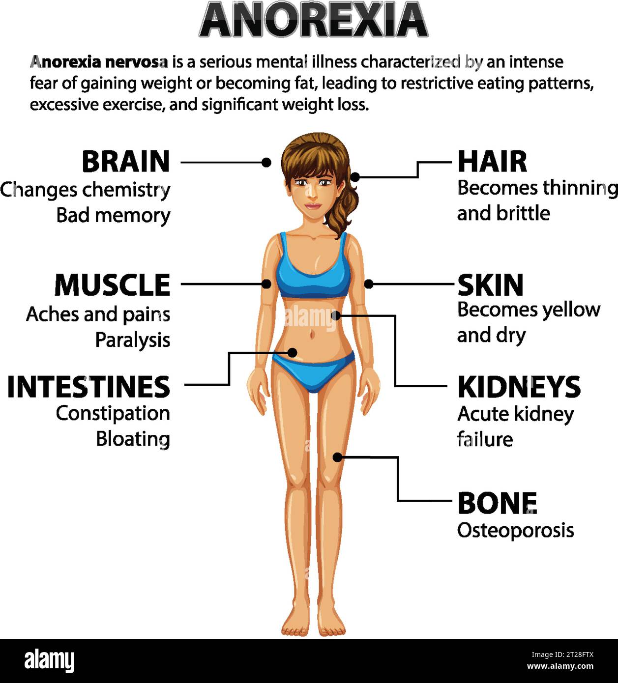 Illustration depicting the impact of Anorexia on various body functions Stock Vector Image & Art ...