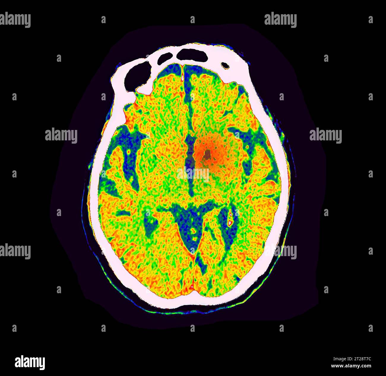 CT Brain Perfusion or CT scan image of the brain axial view showing ...