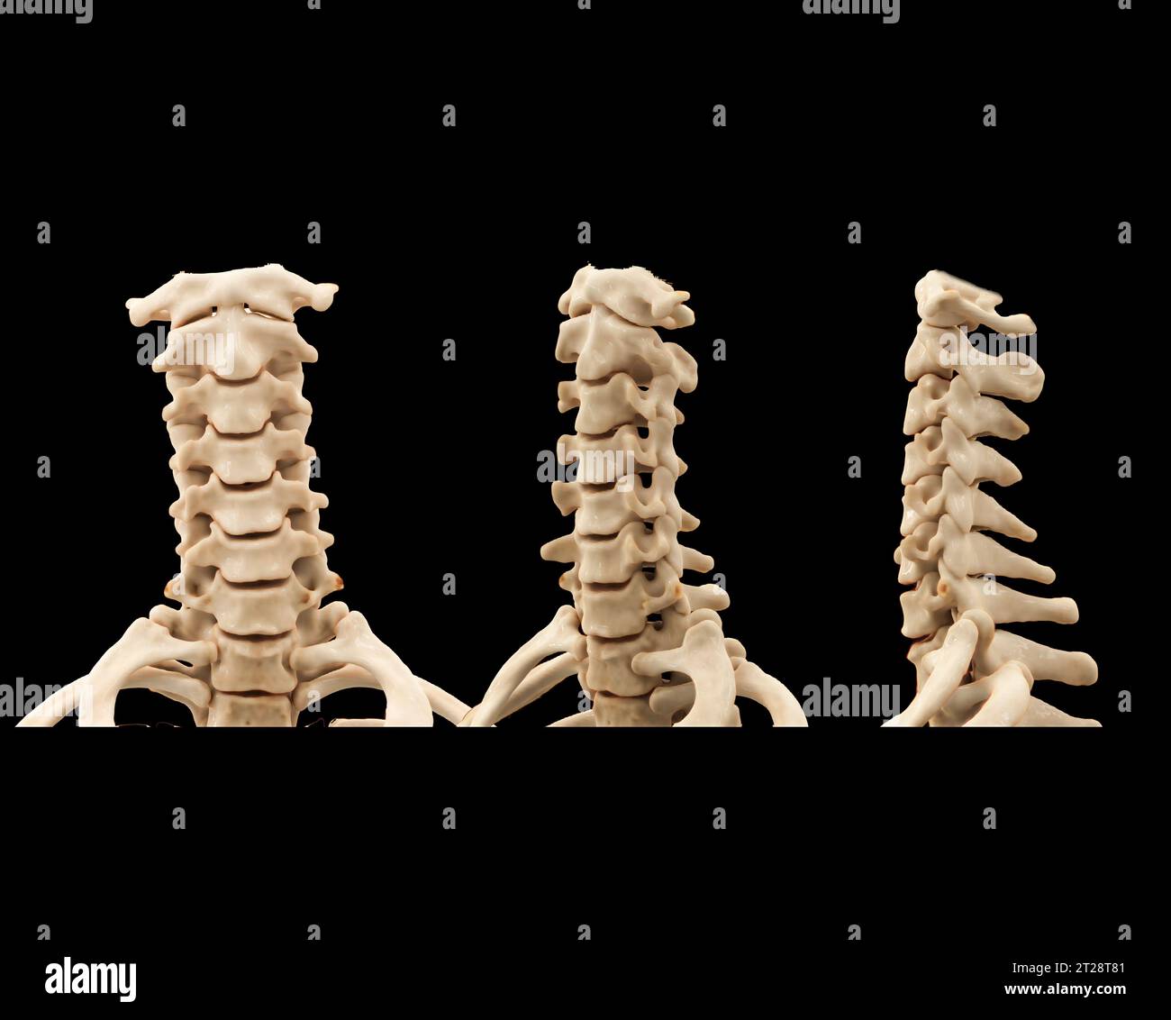 CT scan of C-Spine or Cervical spine 3D rendering for diagnosis ...