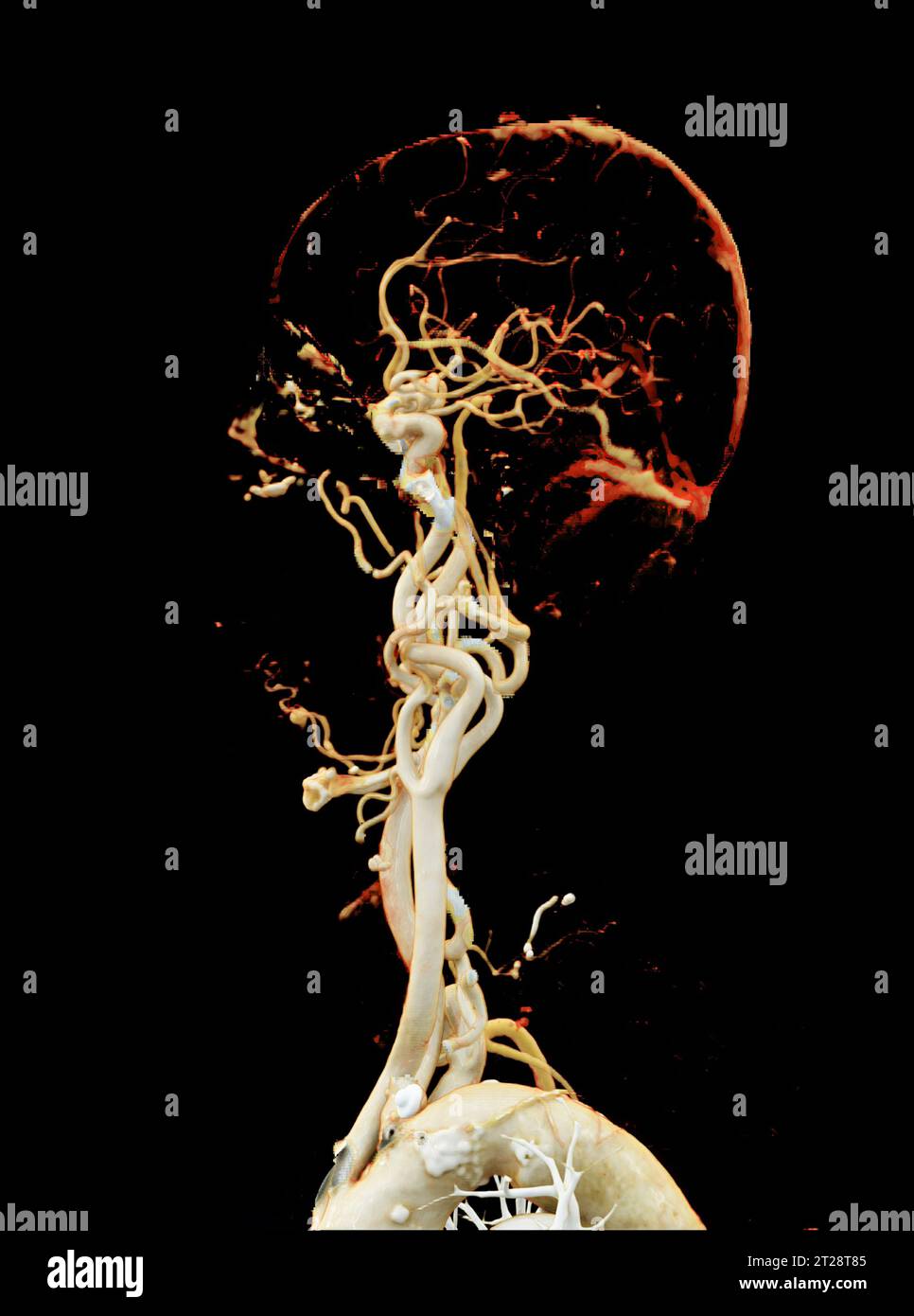 CTA brain and carotid artery or CT angiography of the brain 3D ...