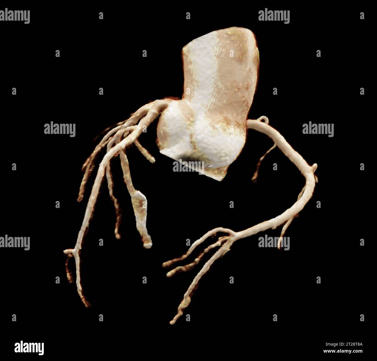 CTA Coronary artery 3D rendering image showing coronary tree and heart ...