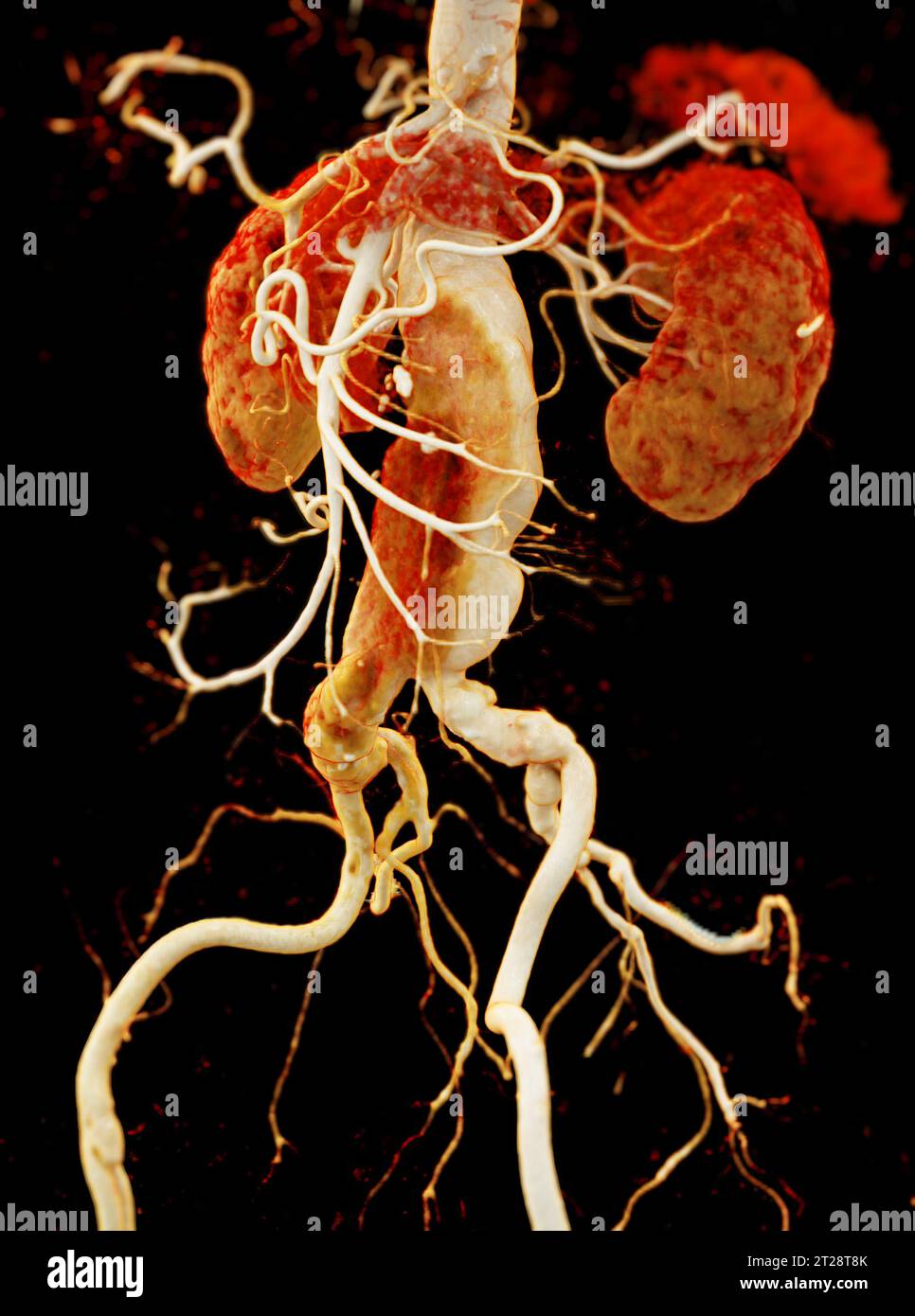 CTA abdominal aorta showing abdomenal aortic dissection 3D rendering ...