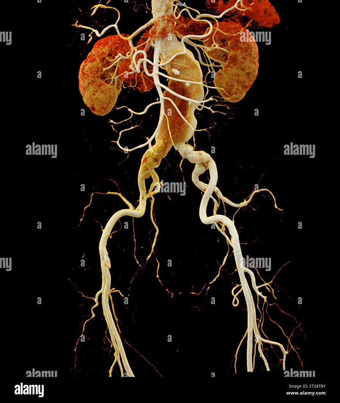 CTA abdominal aorta showing abdomenal aortic dissection 3D rendering ...