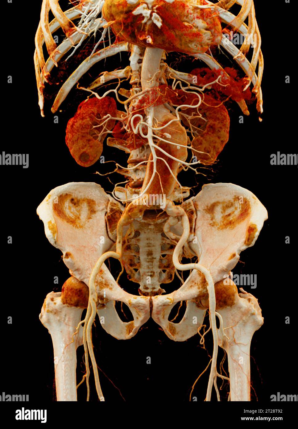 CTA abdominal aorta showing abdomenal aortic dissection 3D rendering ...