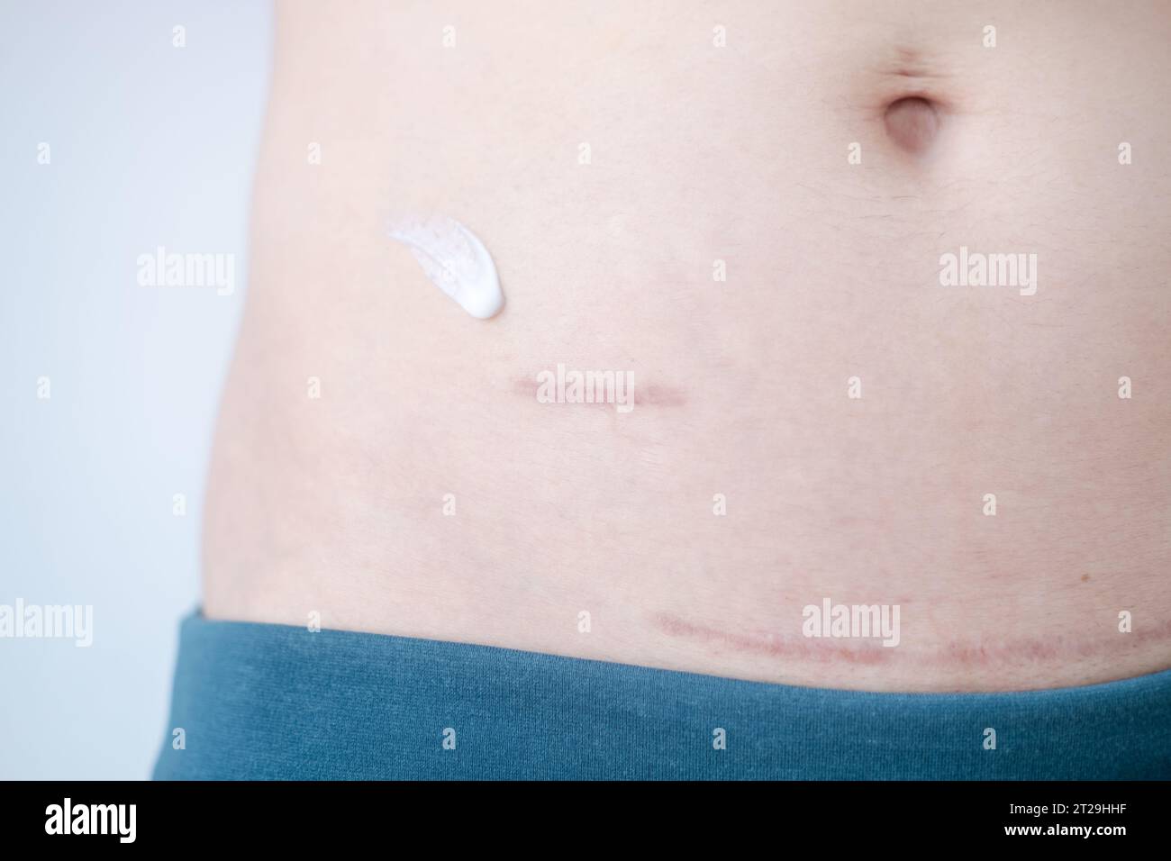 Using cream to care for scars after appendix surgery and postpartum ...