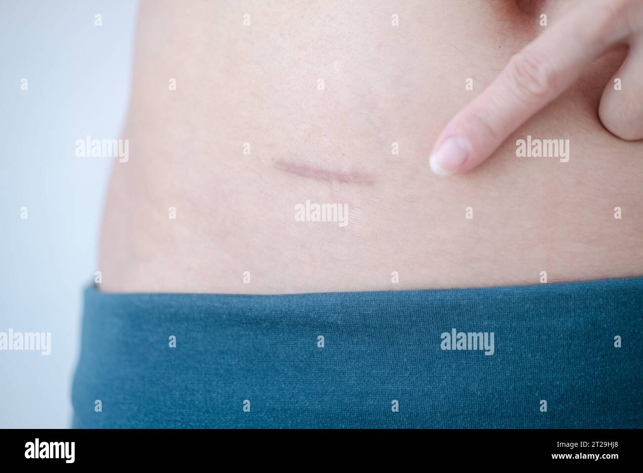 Wound care abdomen hi-res stock photography and images - Alamy