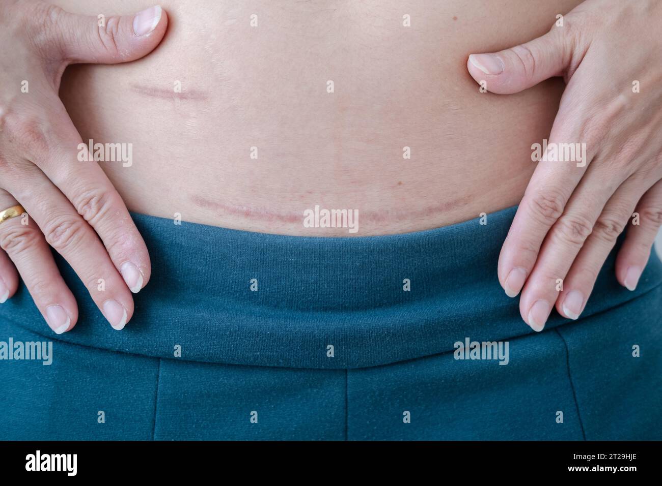 Postpartum scars hi-res stock photography and images - Alamy
