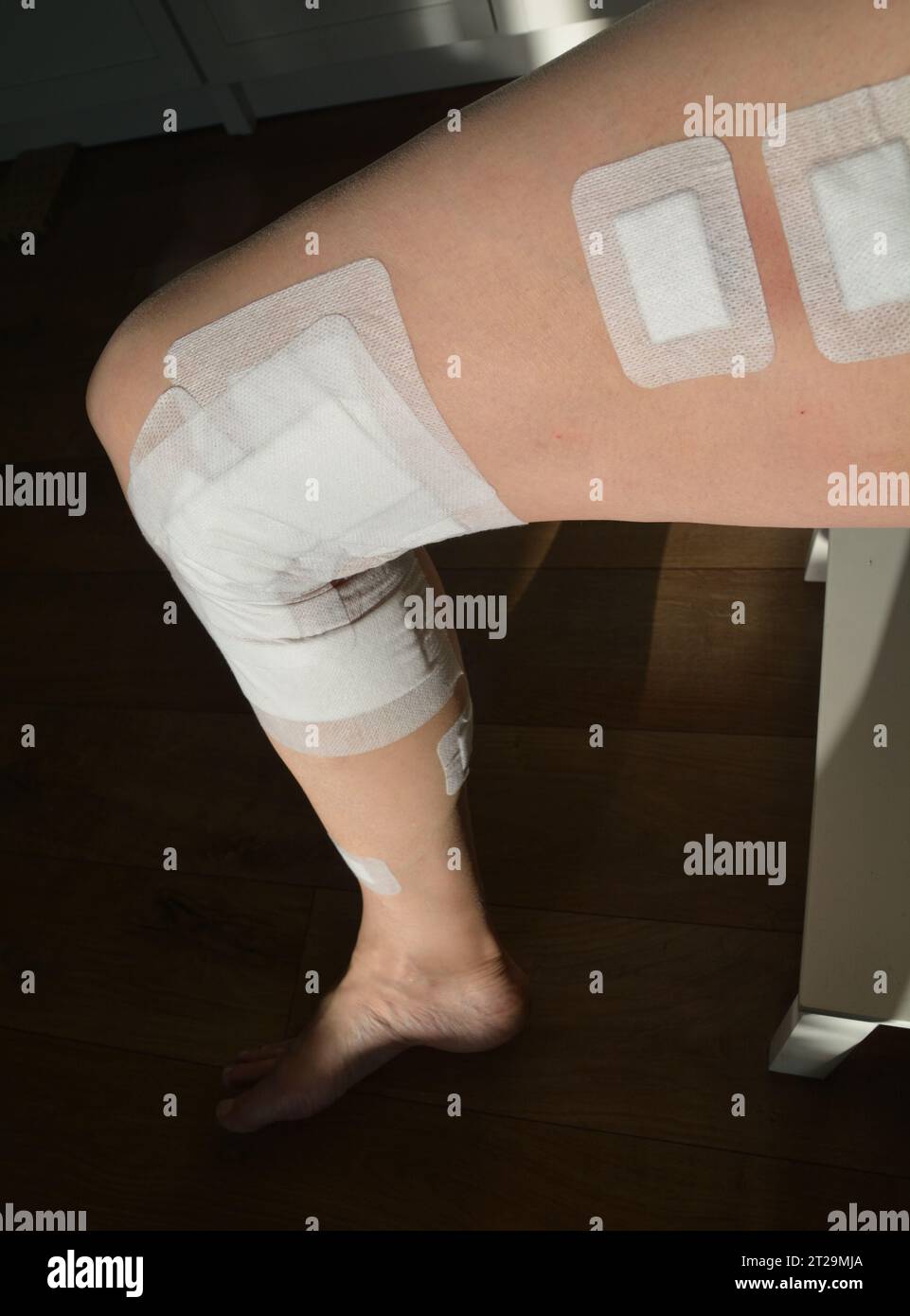 A close-up of a human leg after varicose vein surgery using the newest ...