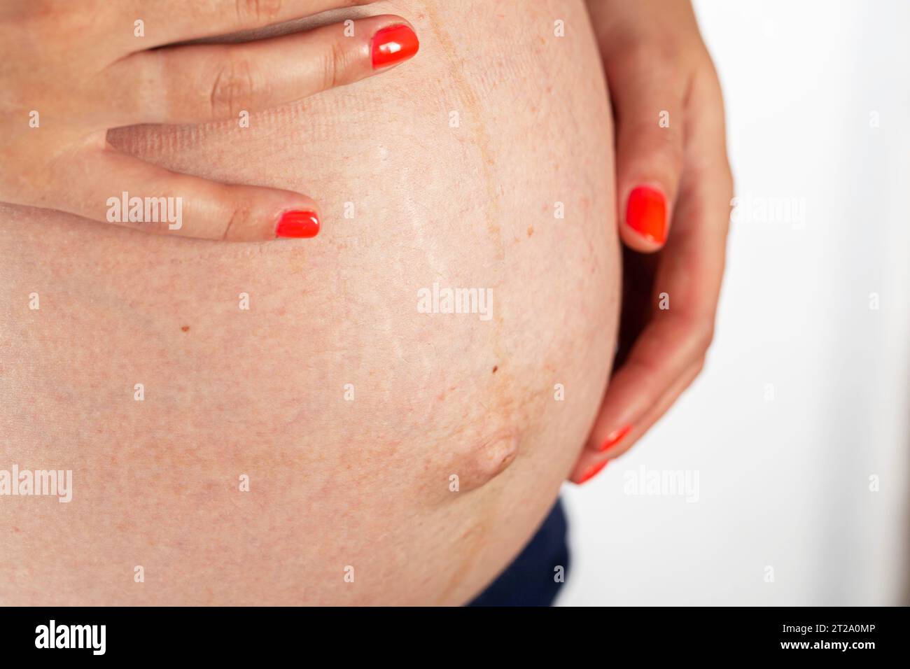 Stretch marks on the abdomen of a pregnant girl, a bulging navel ...
