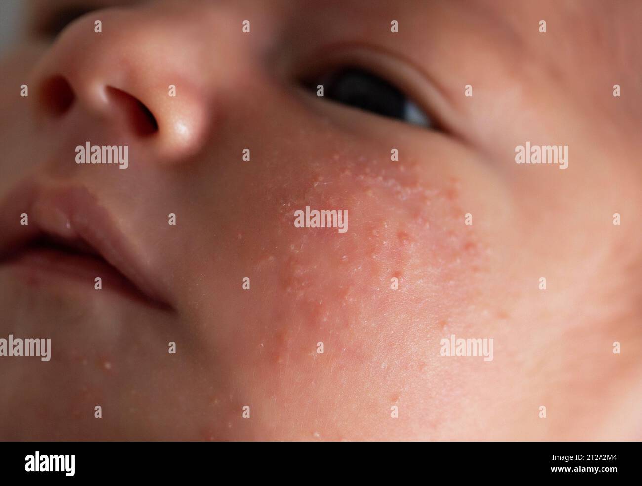 Rash on the face of a newborn baby. The process of formation of the ...